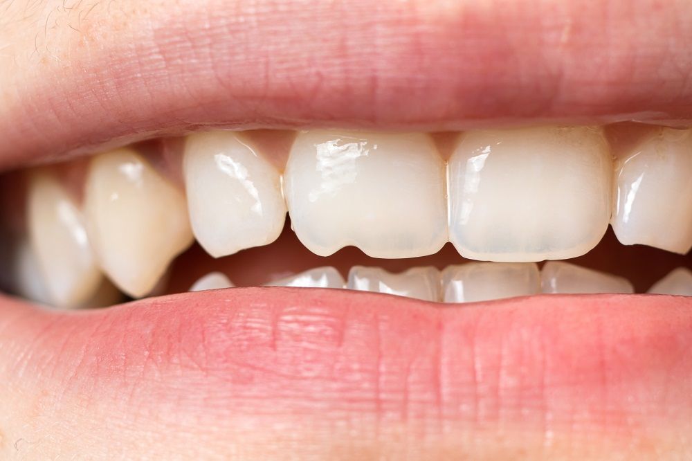 Dental Erosion Can Point to GERD - Philadelphia, PA Dentist